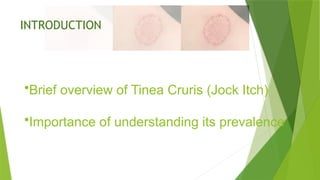 Jock Itch (Tinea Cruris) Jock itch is a contagious fungal infection ...