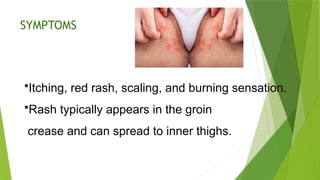 Jock Itch (Tinea Cruris) Jock itch is a contagious fungal infection ...