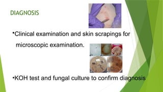 Jock Itch (Tinea Cruris) Jock itch is a contagious fungal infection ...