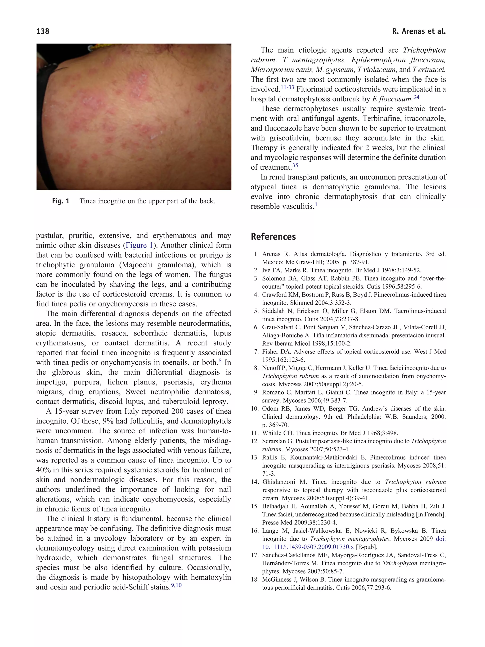 Tinea incognito | PDF