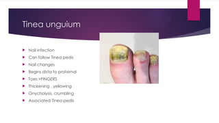 Different types of Tinea infections ppt medicine.pptx