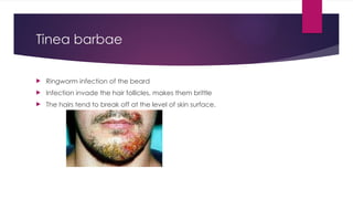 Different types of Tinea infections ppt medicine.pptx