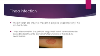 Different types of Tinea infections ppt medicine.pptx