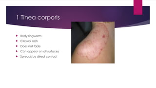 Different types of Tinea infections ppt medicine.pptx