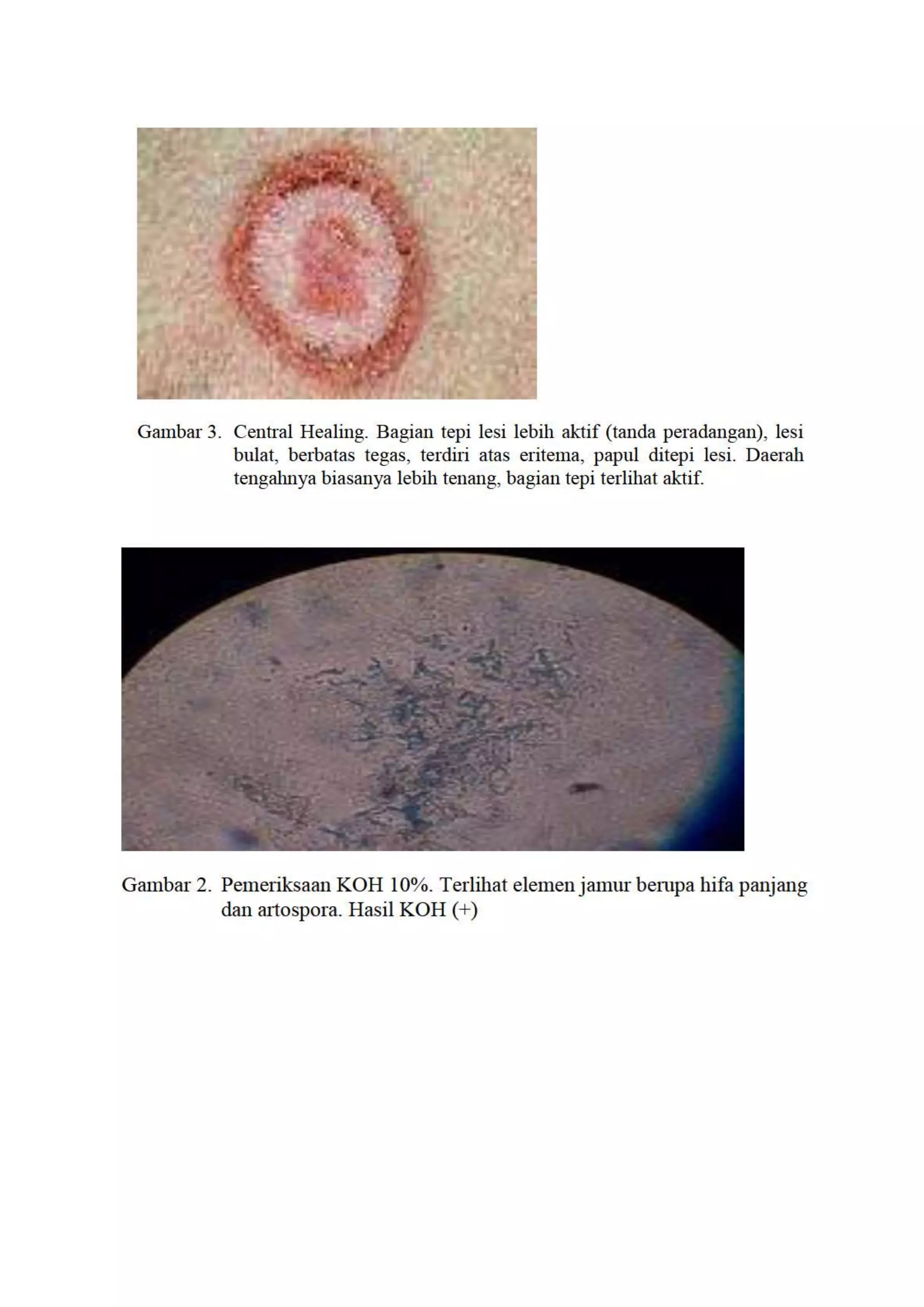 Tinea korporis ( infeksi jamur) | DOCX