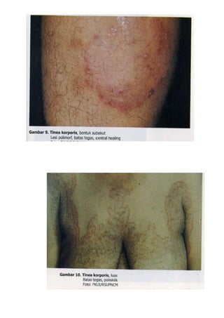 Tinea korporis ( infeksi jamur) | DOCX