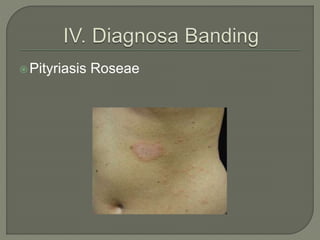 Tinea_Korporis et tinea cruris_power_point.pptx