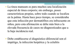 Tinea manuum | PPTX
