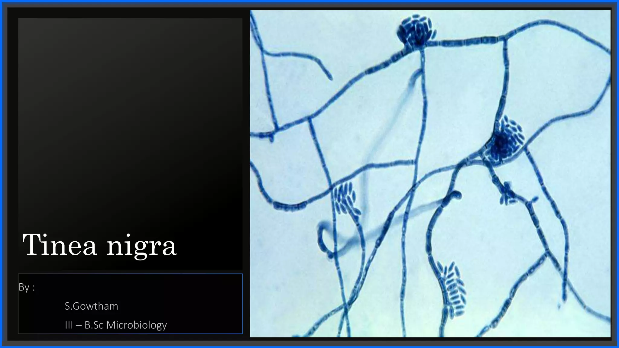 Tinea nigra presentation | PPTX