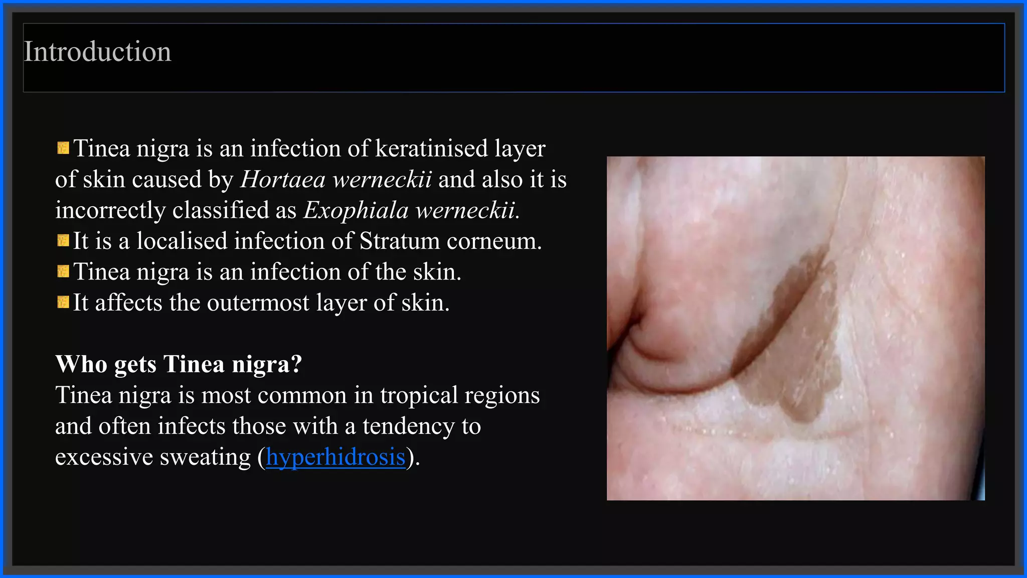 Tinea nigra presentation | PPTX