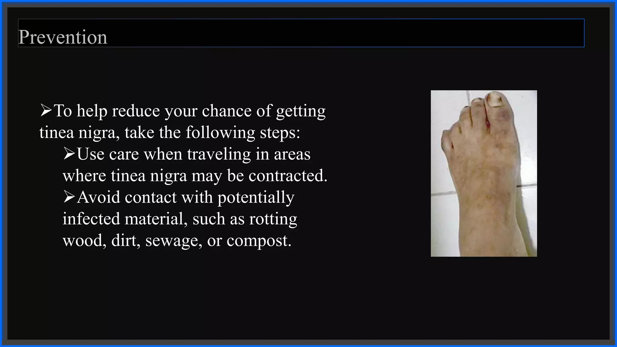Tinea nigra presentation | PPTX