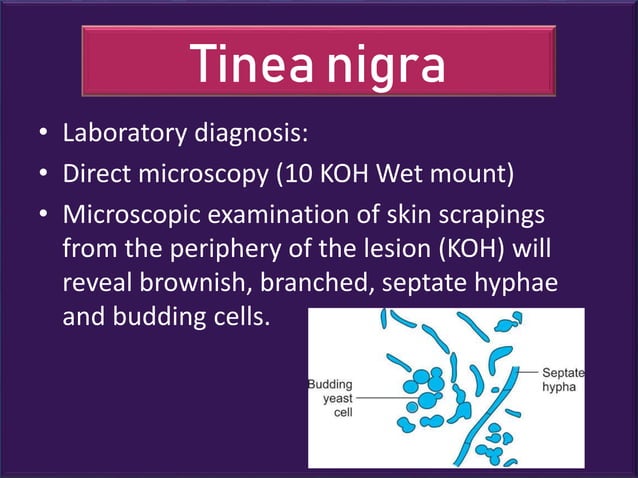 Tinea nigra (Hortaea werneckii)ppt .pptx | Skin and Dermatology ...