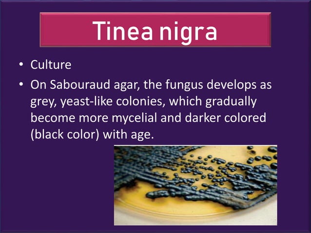 Tinea nigra (Hortaea werneckii)ppt .pptx | Skin and Dermatology ...