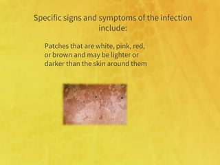 tinea versi.pdf