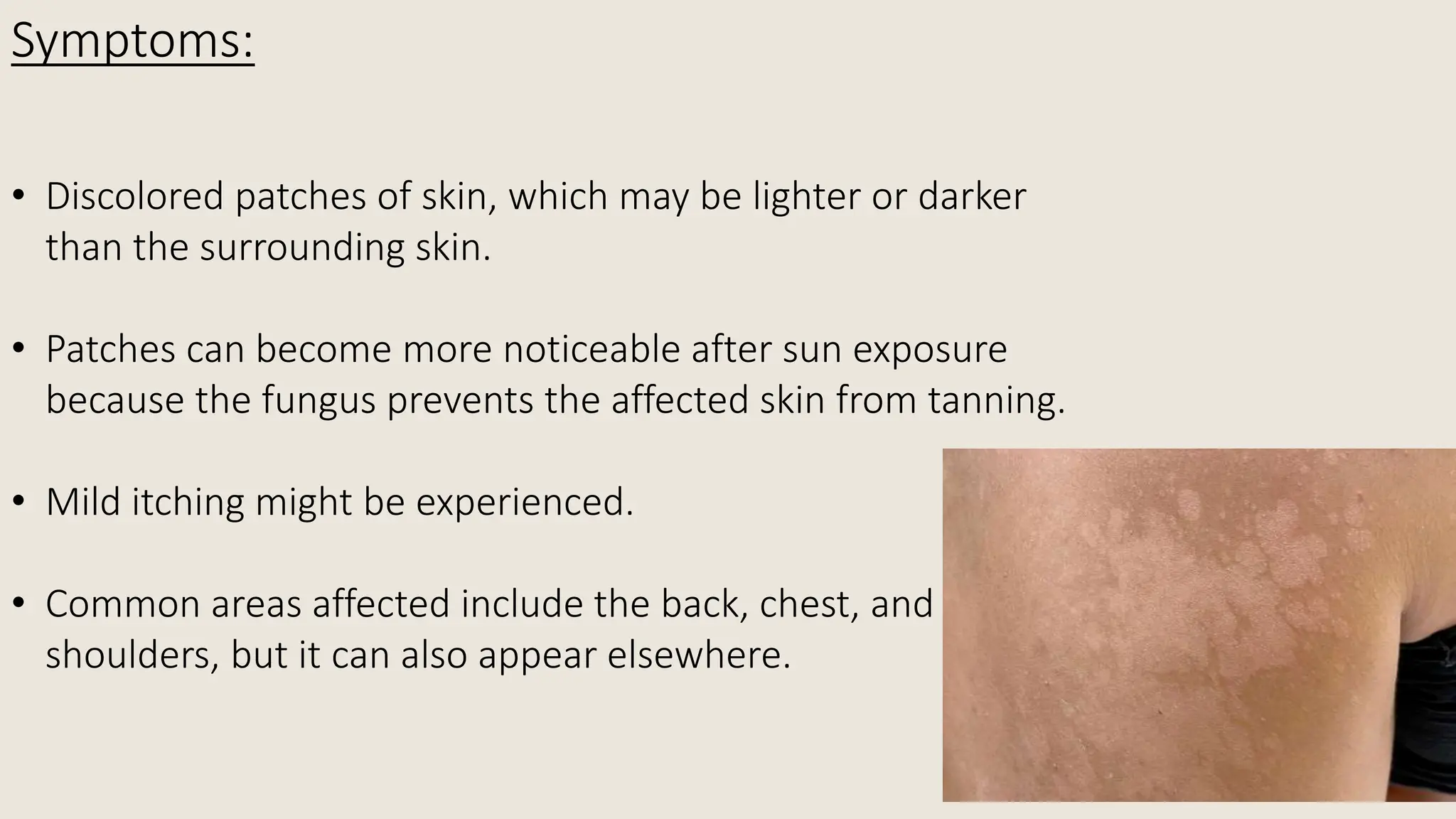 Tinea versicolor (Pityriasis versicolor, is a common fungal infection ...