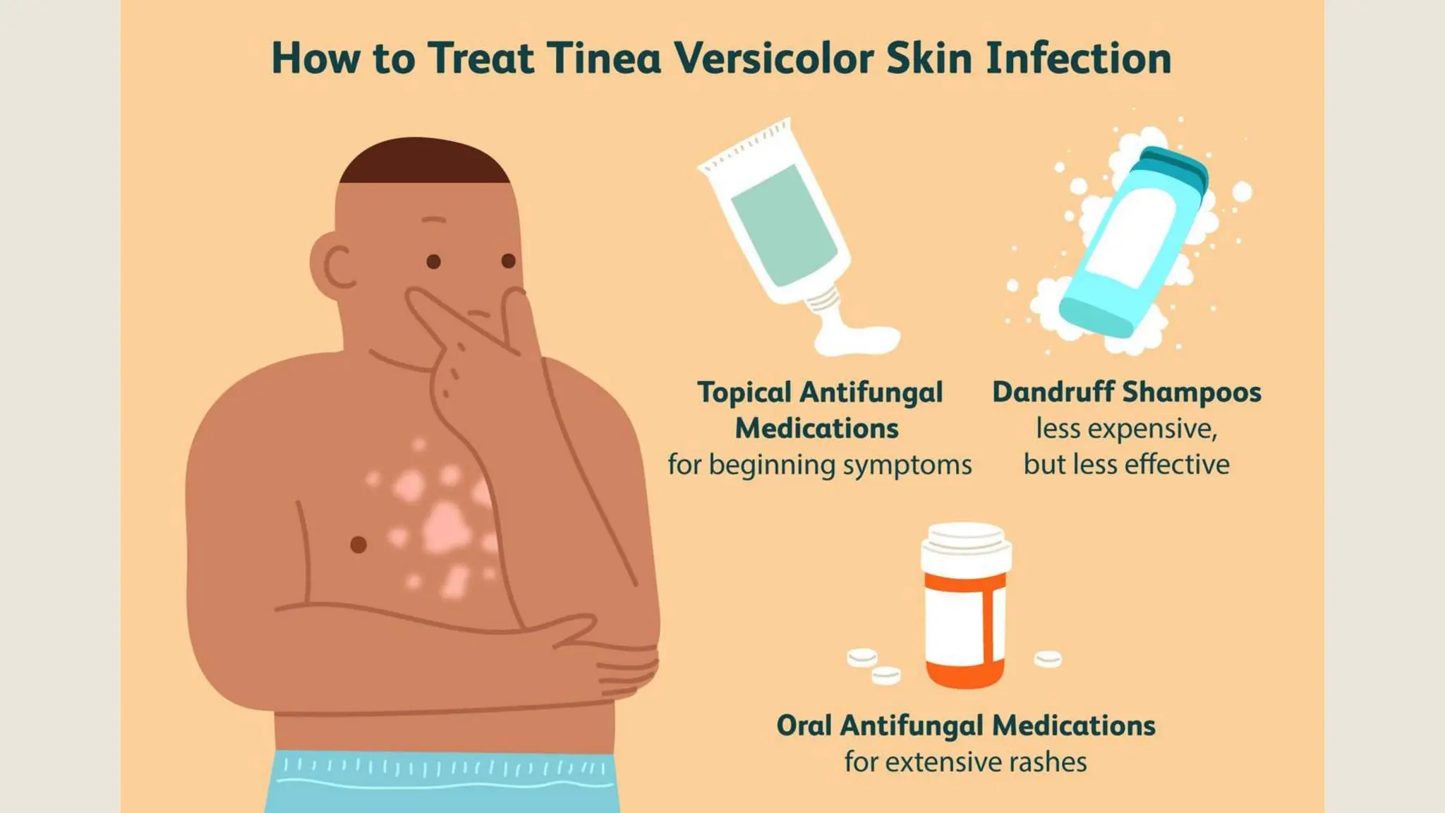 Tinea versicolor (Pityriasis versicolor, is a common fungal infection ...