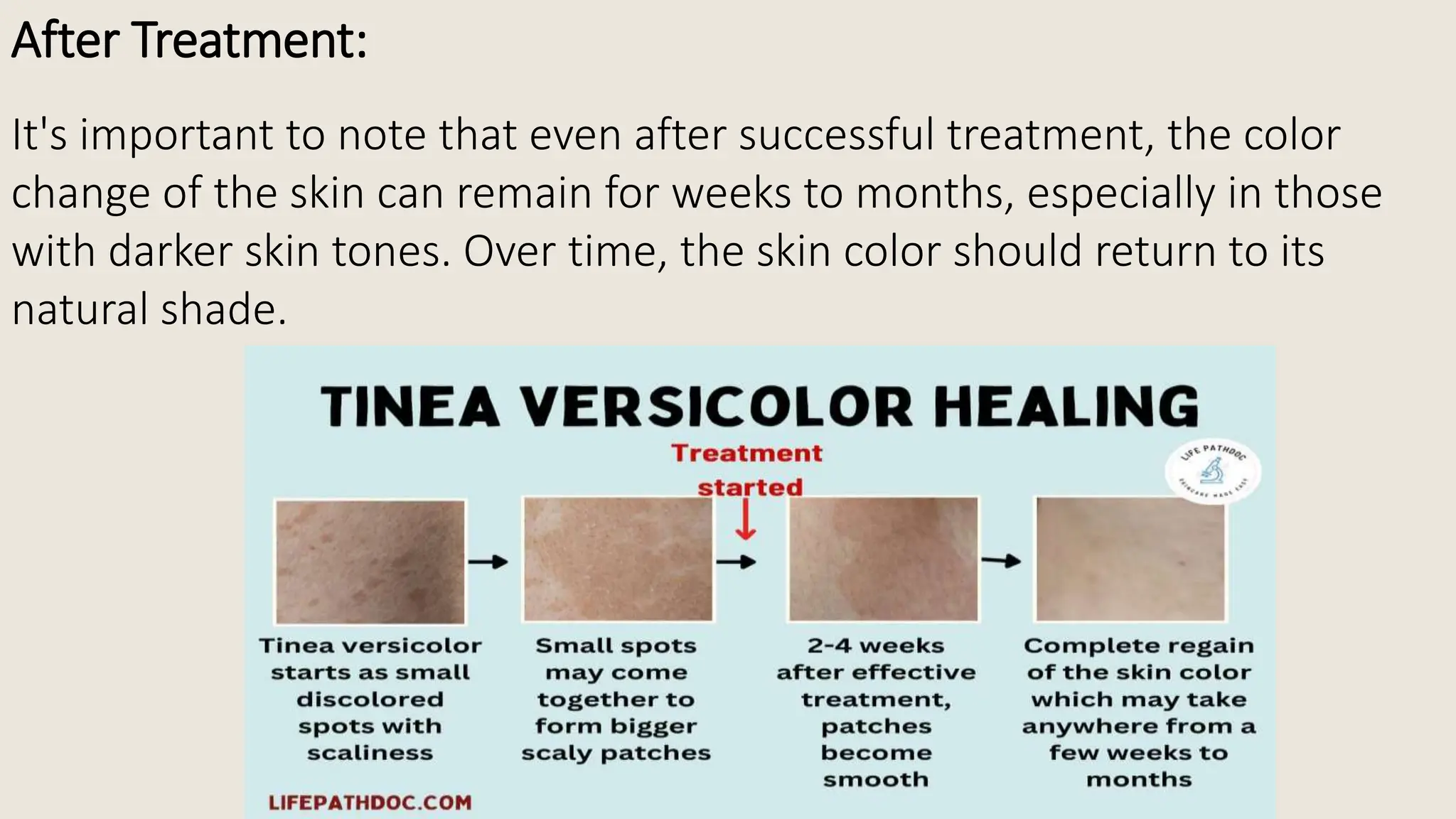 Tinea versicolor (Pityriasis versicolor, is a common fungal infection ...