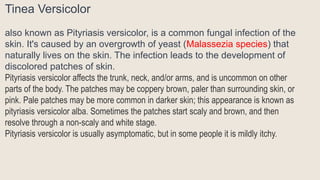 Tinea versicolor (Pityriasis versicolor, is a common fungal infection ...
