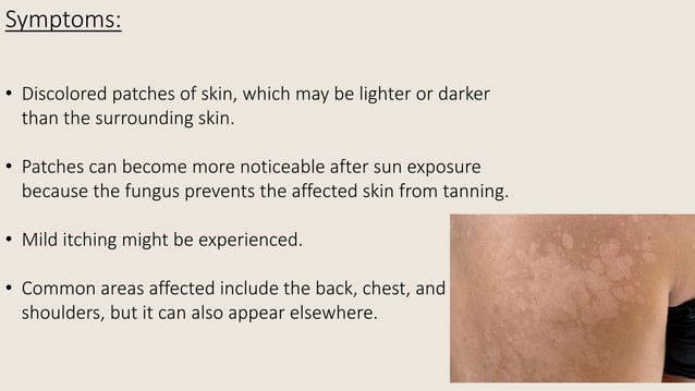 Tinea versicolor (Pityriasis versicolor, is a common fungal infection ...