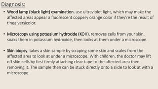 Tinea versicolor (Pityriasis versicolor, is a common fungal infection ...