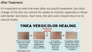 Tinea versicolor (Pityriasis versicolor, is a common fungal infection ...