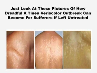 Tinea Versicolor Stomach | PPTX | Skin and Dermatology | Diseases and ...