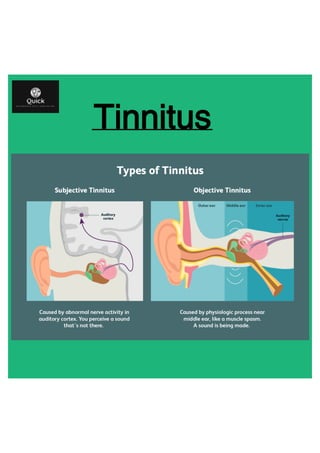 Tinnitus .pdf ENT by QuickMedTalk....... | PDF