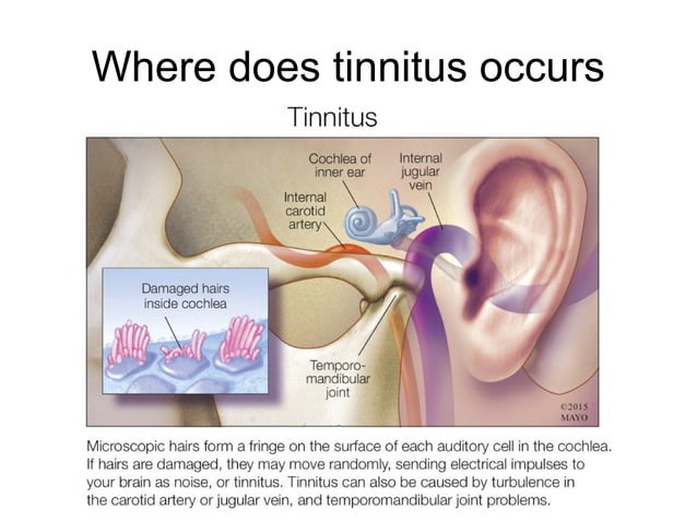 Tinnitus review | PPT