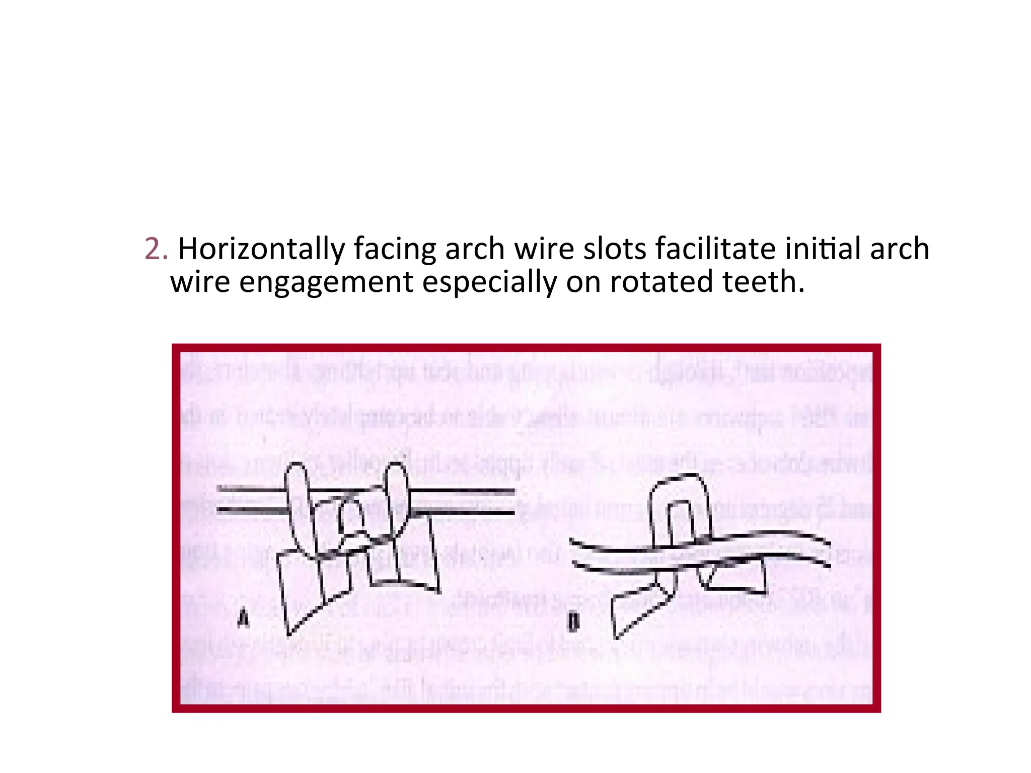 Tip-Edge Orthodontic Appliance System ORTHODONTICS | PPT