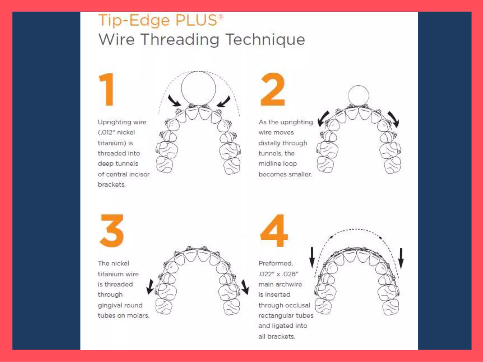 Tip edge appliance | PPTX