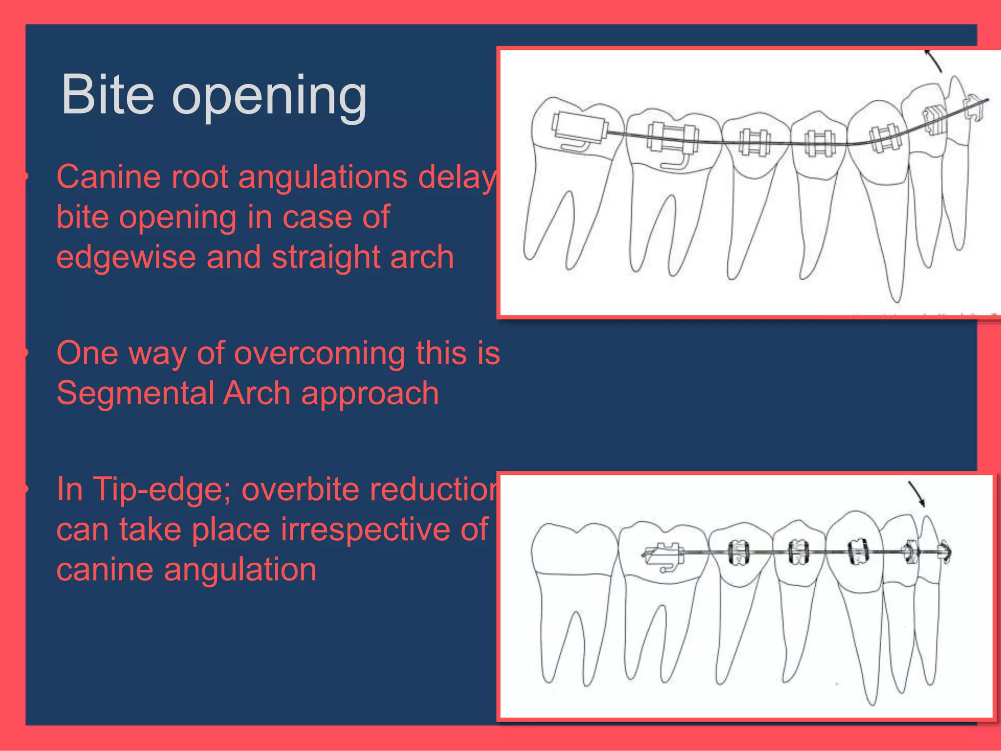Tip edge appliance | PPTX