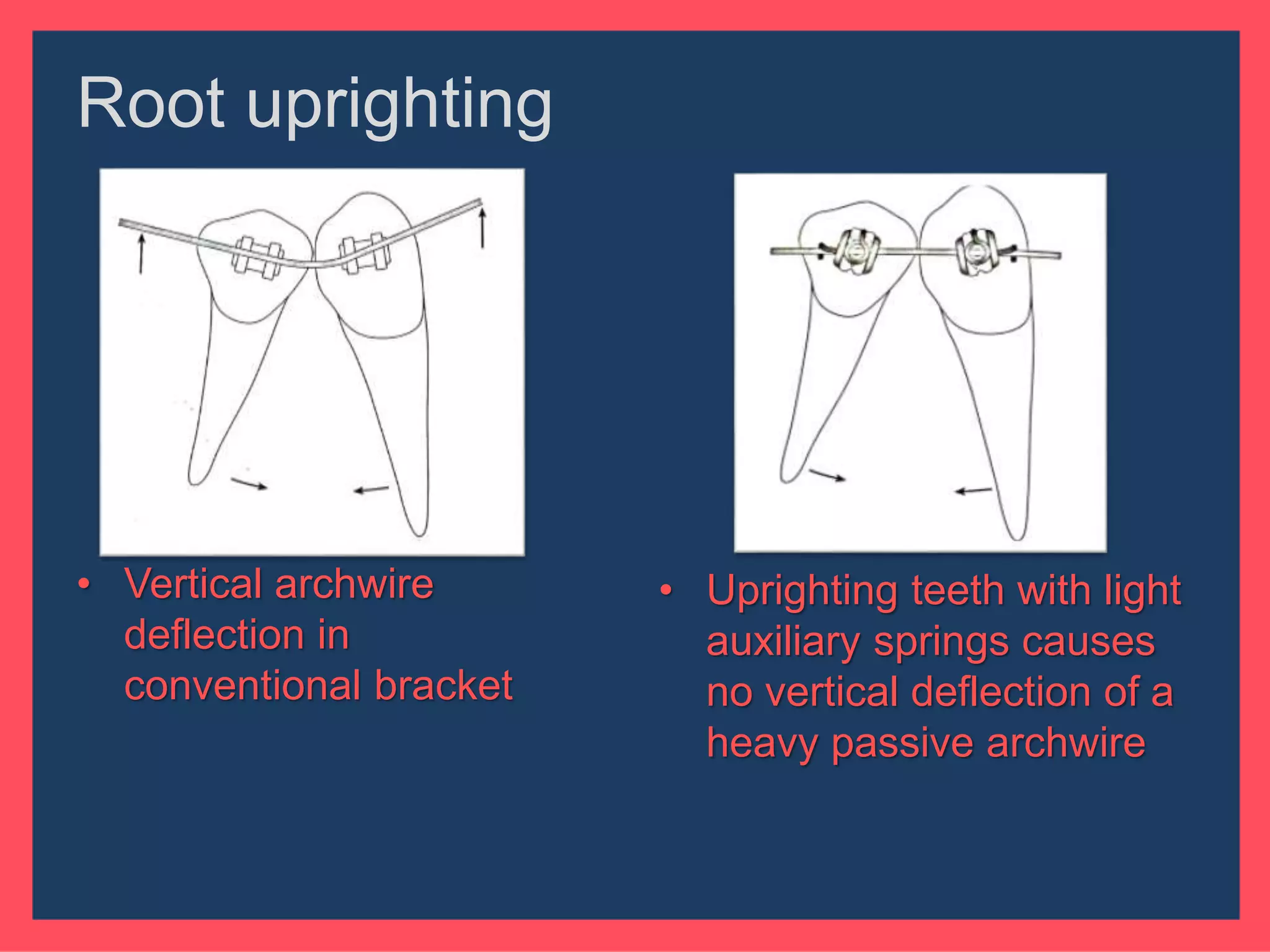 Tip edge appliance | PPTX