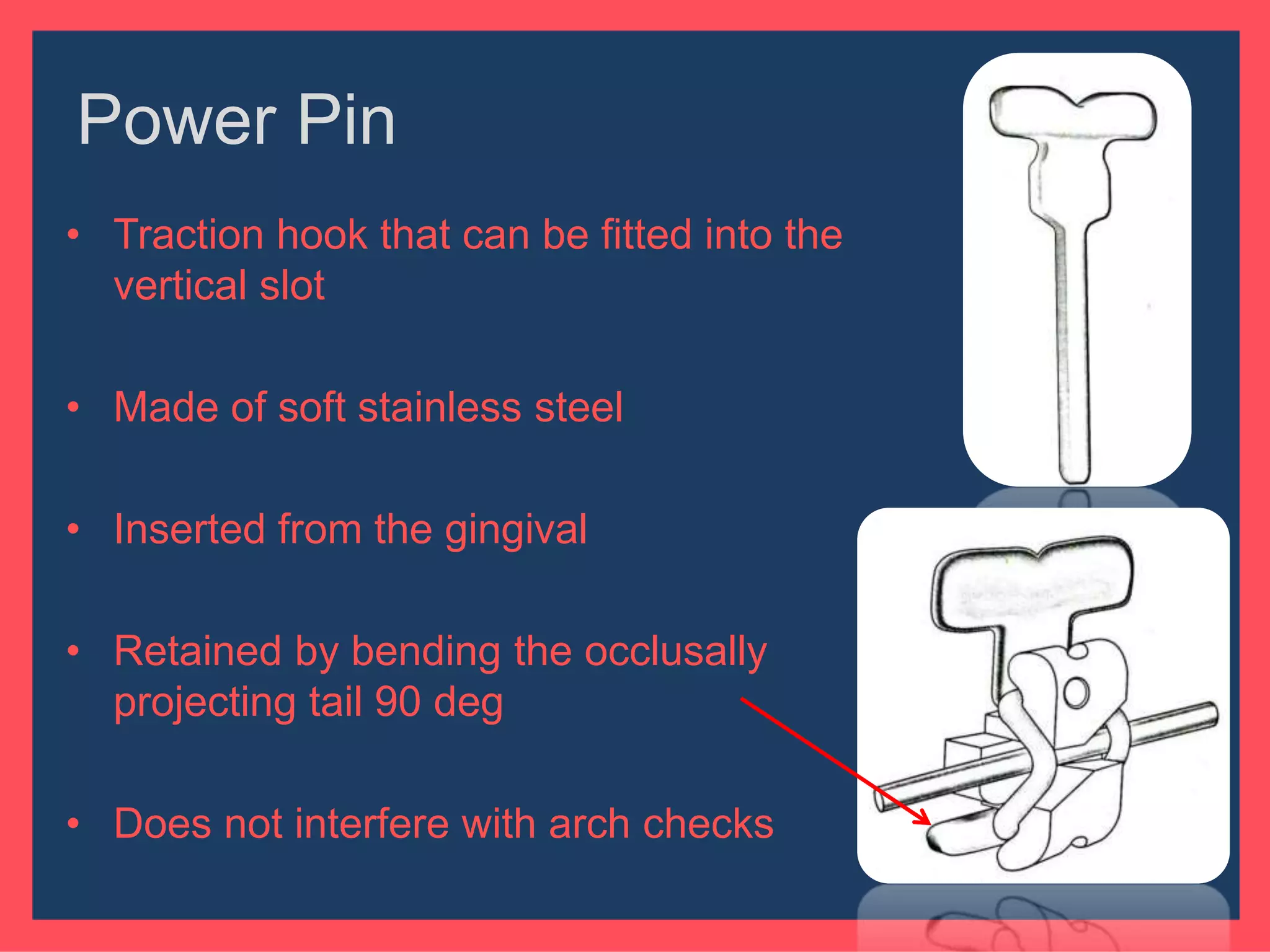 Tip edge appliance | PPTX