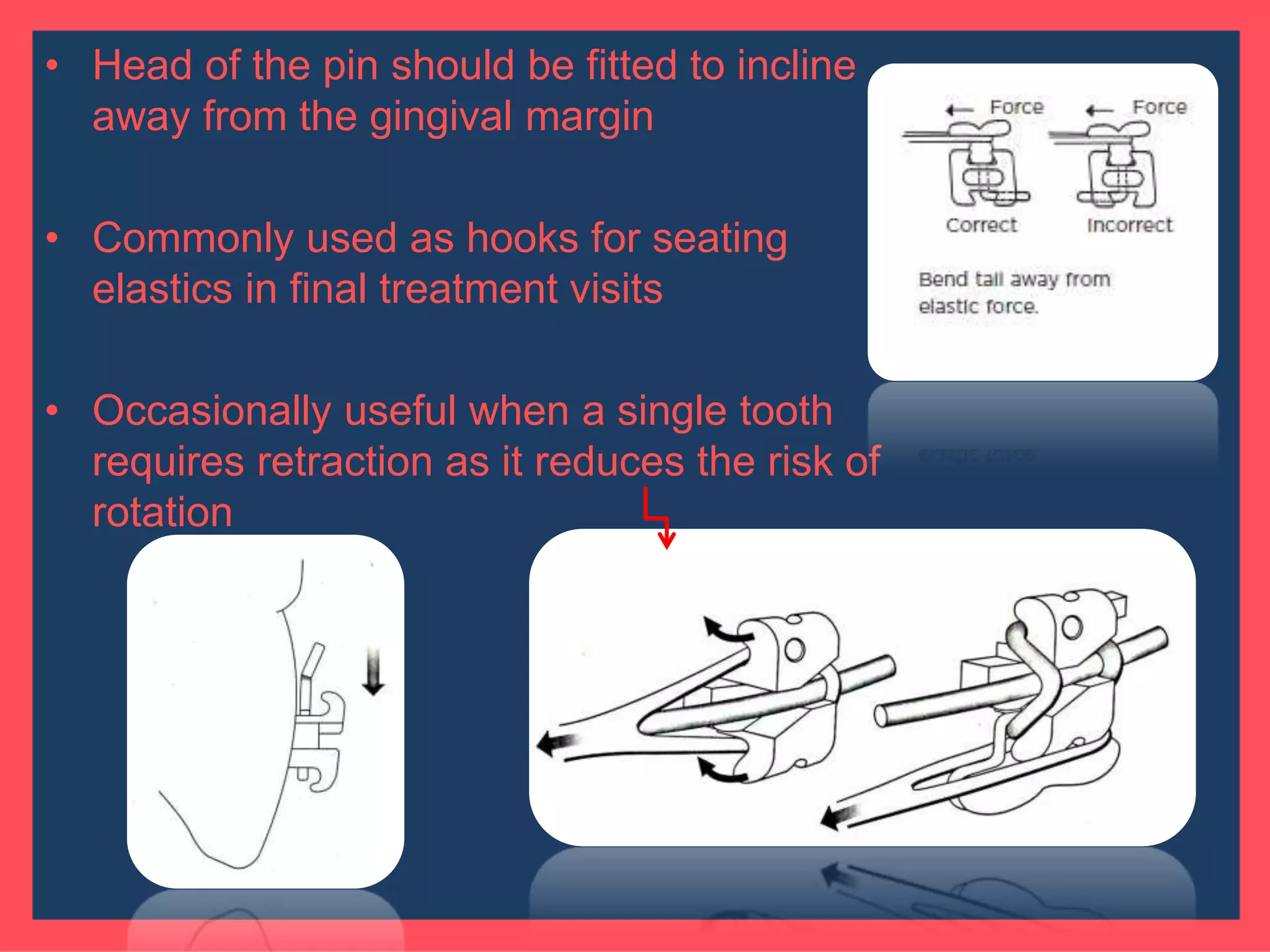 Tip edge appliance | PPTX