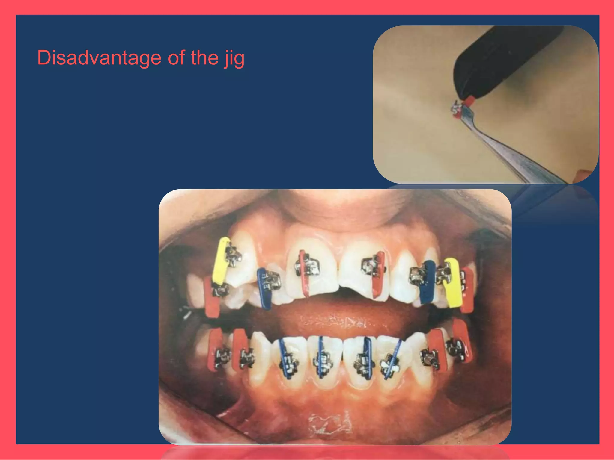 Tip edge appliance | PPTX