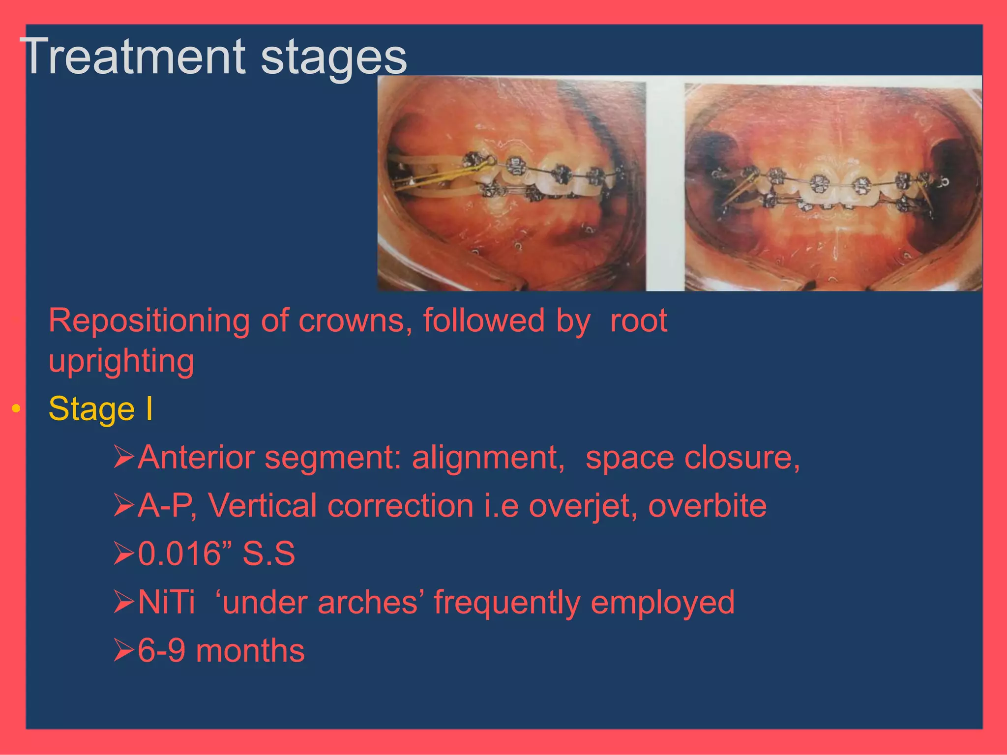 Tip edge appliance | PPTX