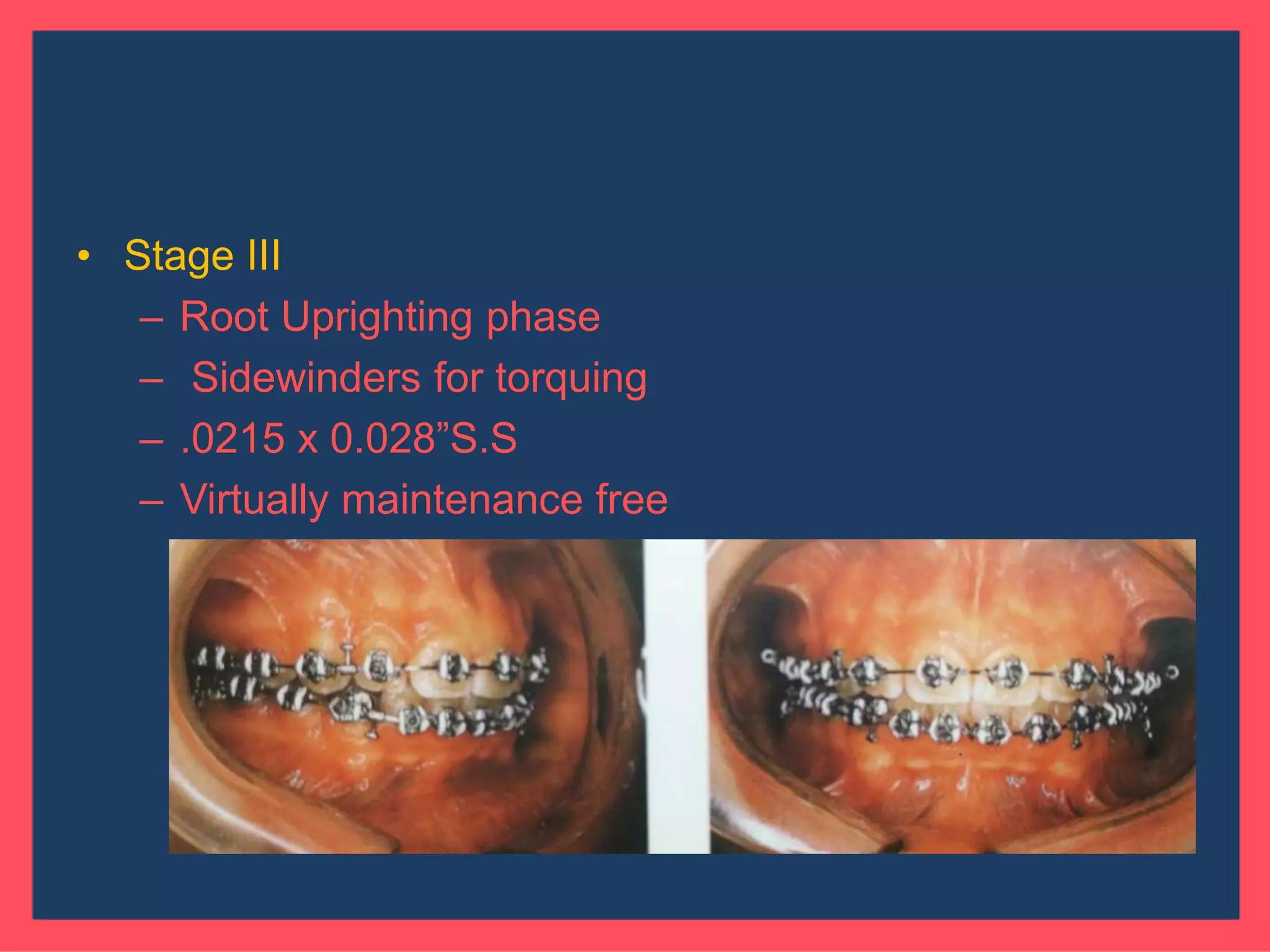 Tip edge appliance | PPTX