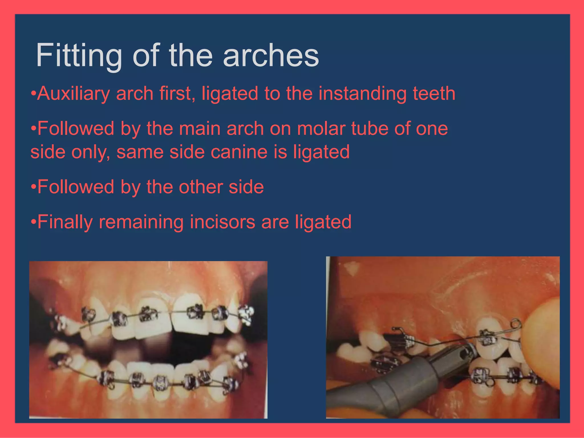 Tip edge appliance | PPTX