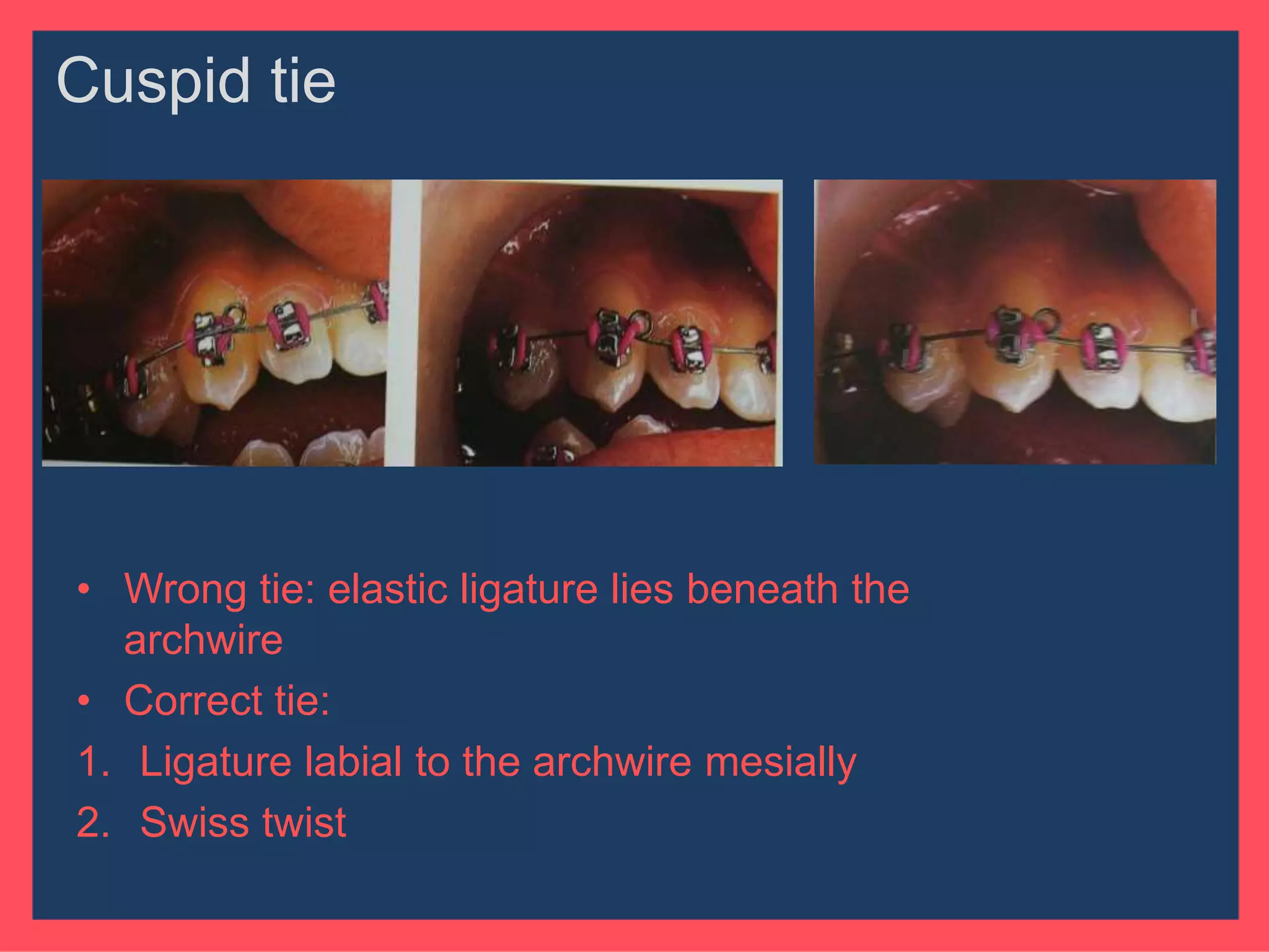 Tip edge appliance | PPTX