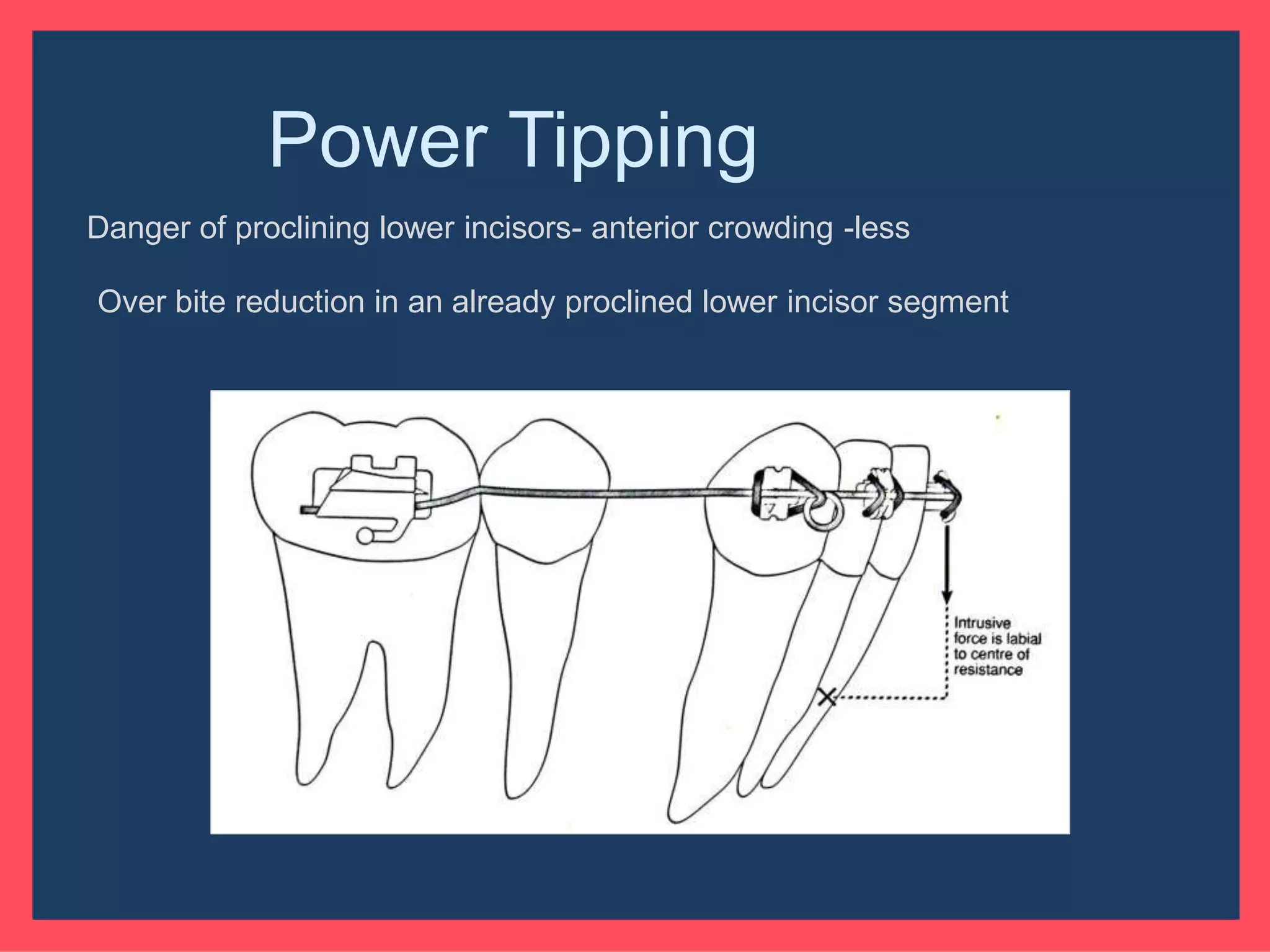 Tip edge appliance | PPTX