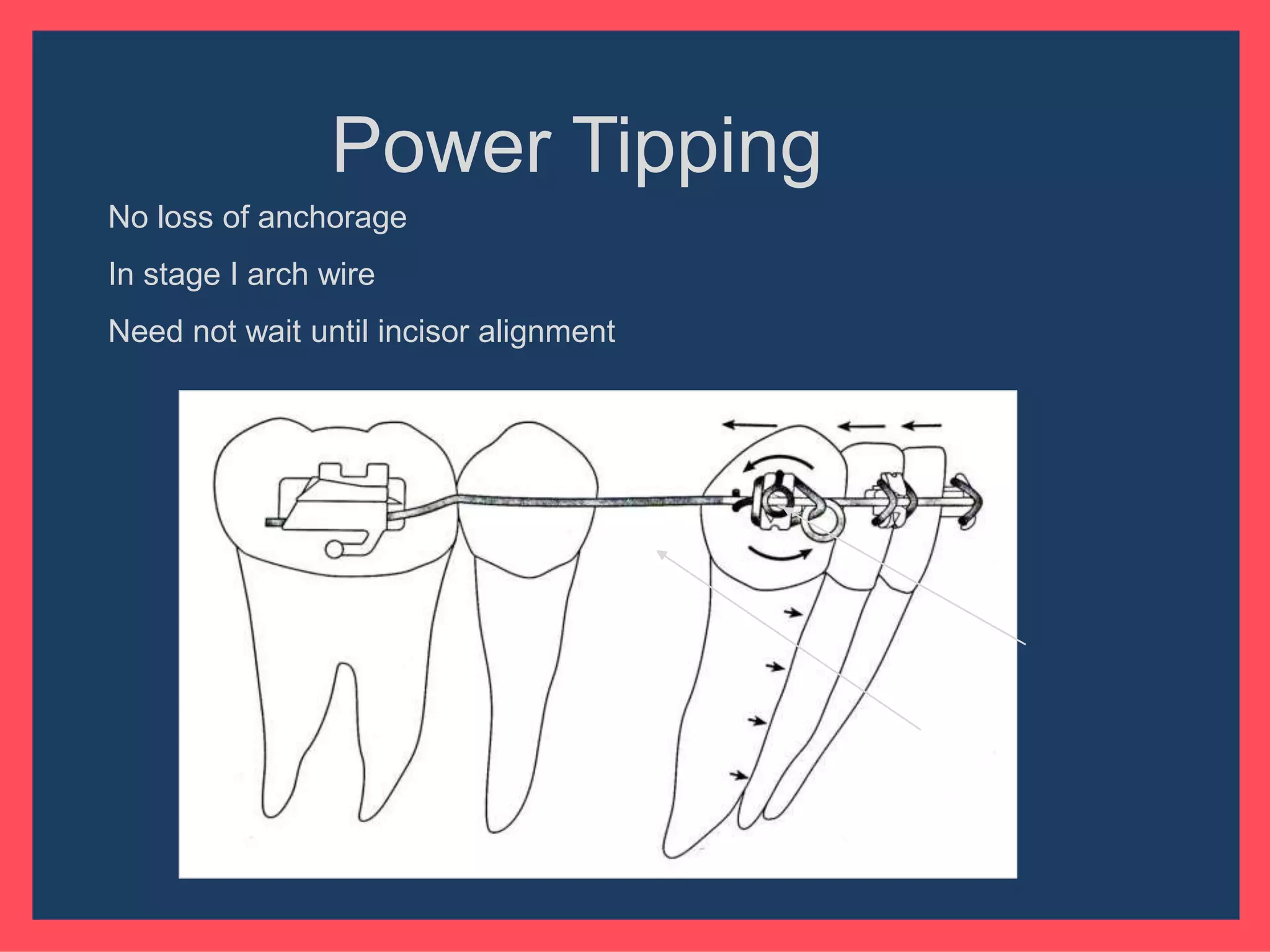 Tip edge appliance | PPTX