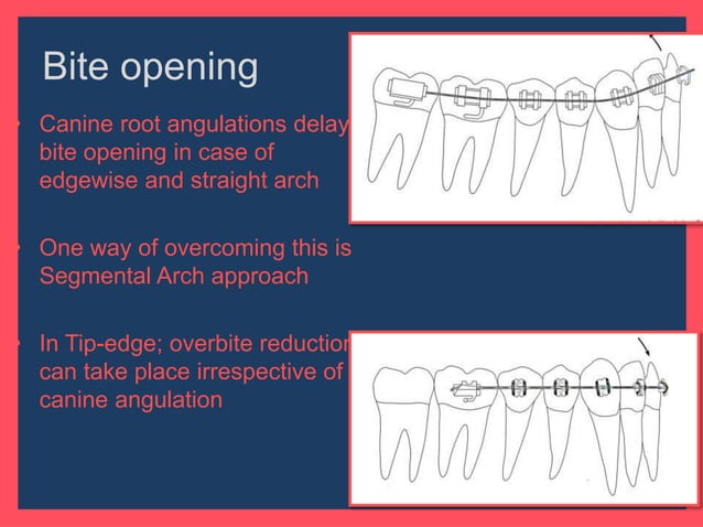 Tip edge appliance | PPTX