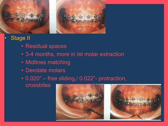 Tip edge appliance | PPTX