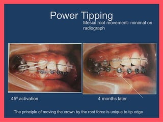 Tip edge appliance | PPTX
