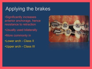 Tip edge appliance | PPTX