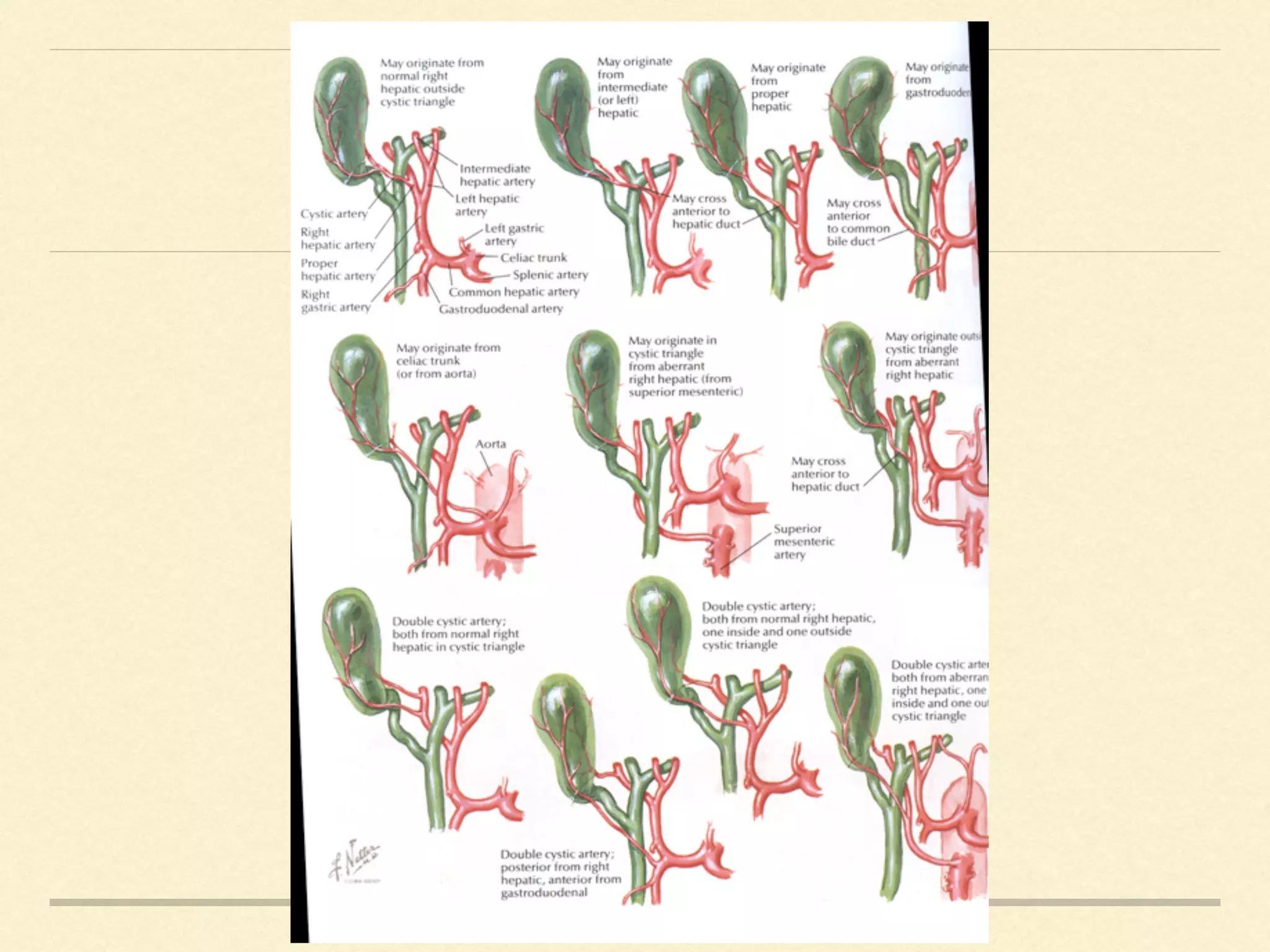 Tip and technique for safe LC | PPT