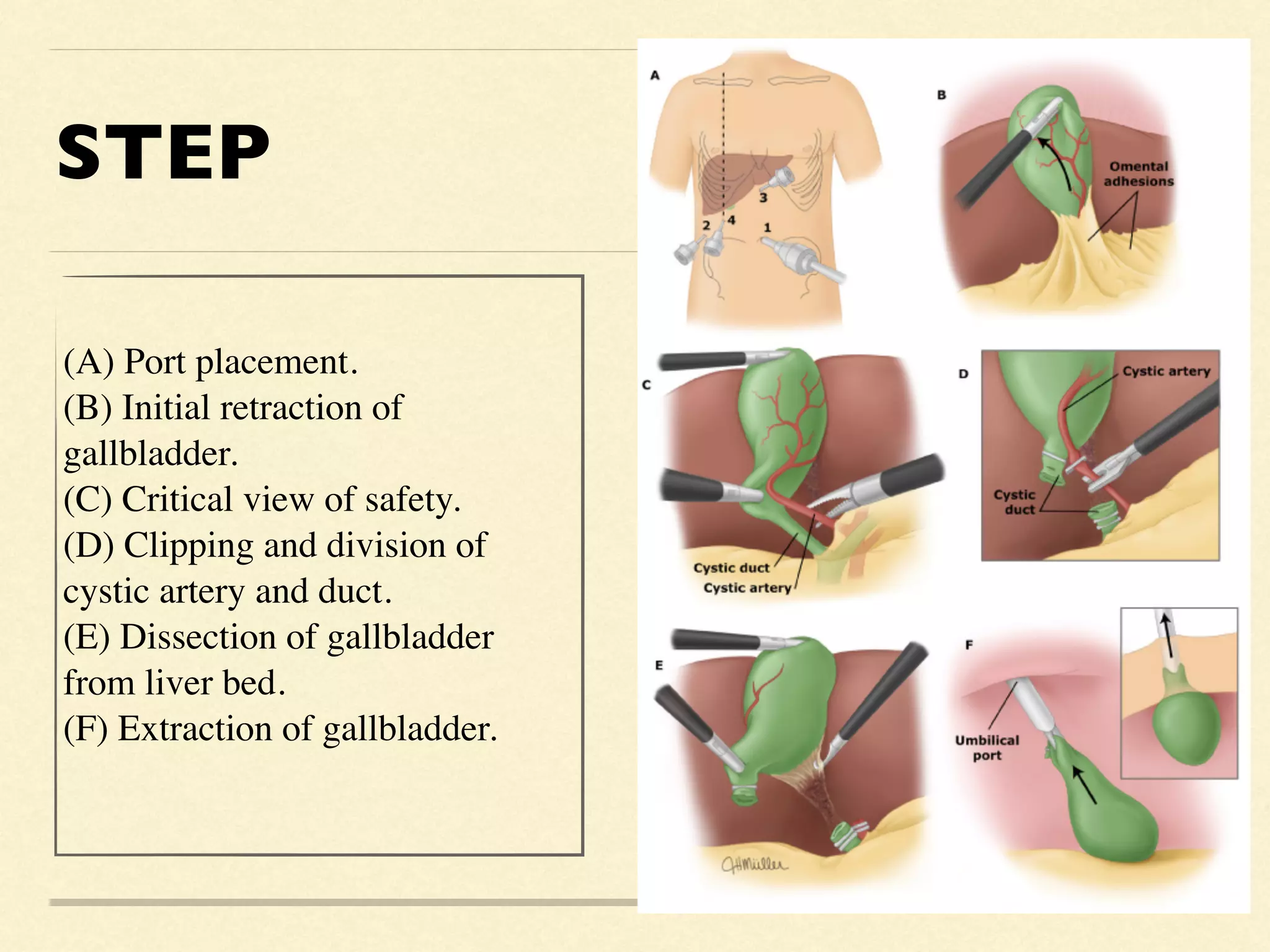 Tip and technique for safe LC | PDF