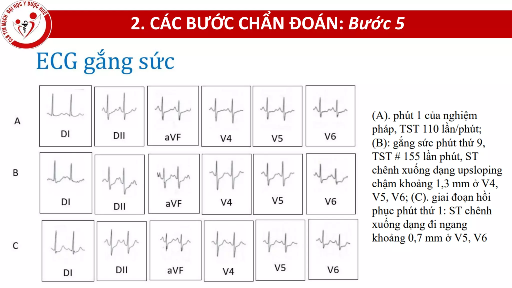 Tiếp cận chẩn đoán hội chứng vành mạn.pdf