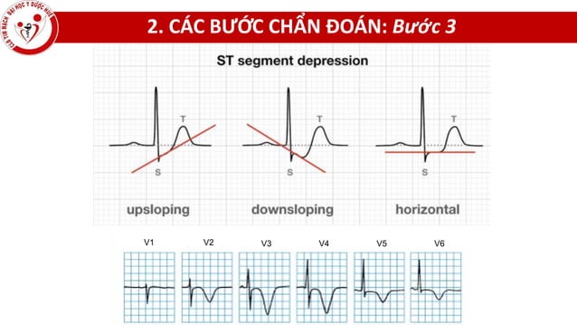Tiếp cận chẩn đoán hội chứng vành mạn.pdf