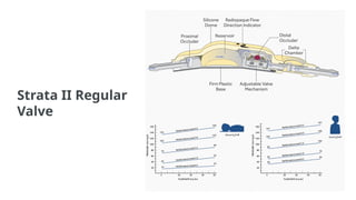 tipe tipe shunt yang biasanya digunakan untuk operasi BS | PPTX